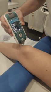 Mechanical properties of the patellar tendon in weightlifting athletes ...